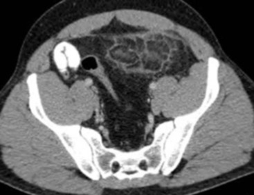Imaging of The Peritoneum, Mesentery and Omentum