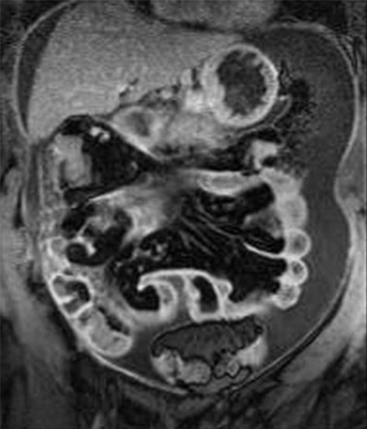 Imaging of The Peritoneum, Mesentery and Omentum