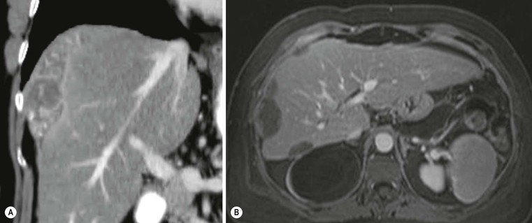 Imaging of The Peritoneum, Mesentery and Omentum