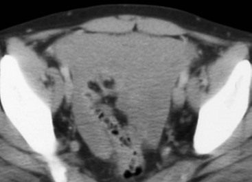Imaging of The Peritoneum, Mesentery and Omentum