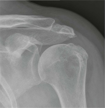 Internal Derangements of Joints
