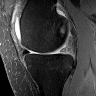 Internal Derangements of Joints