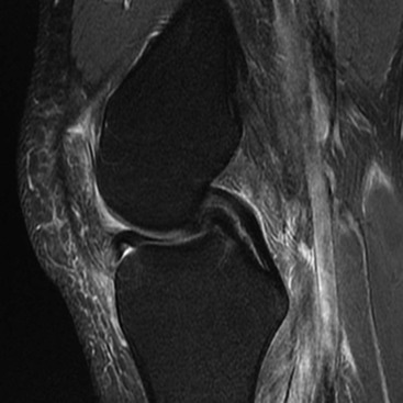 Internal Derangements of Joints