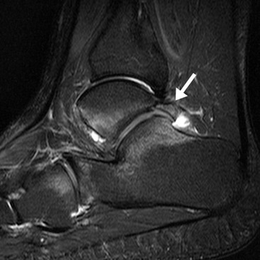 Internal Derangements of Joints