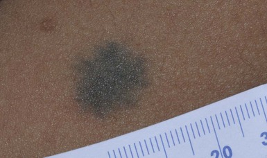 Disorders of Hyperpigmentation and Melanocytes