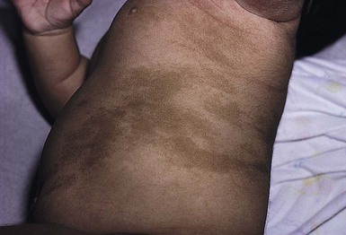 Disorders of Hyperpigmentation and Melanocytes