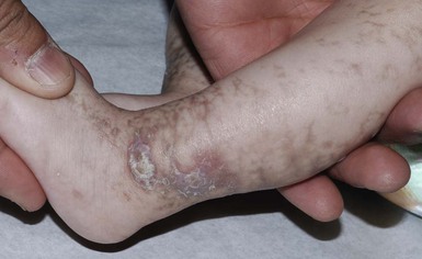Disorders of Hyperpigmentation and Melanocytes