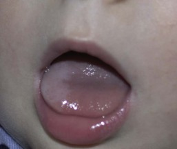 Neonatal Mucous Membrane Disorders