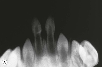 Neonatal Mucous Membrane Disorders