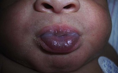 Neonatal Mucous Membrane Disorders