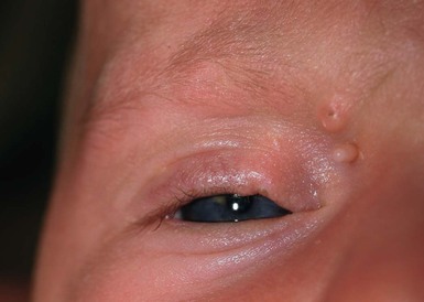 Neonatal Mucous Membrane Disorders