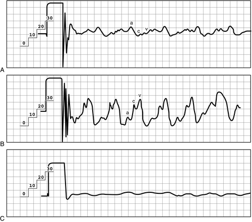 Hemodynamic Monitoring