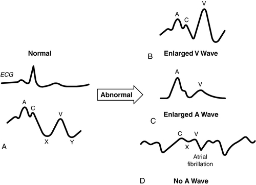 Hemodynamic Monitoring