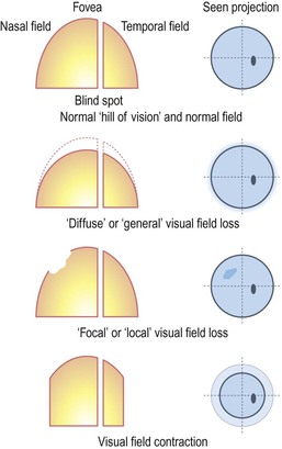 Visual Fields