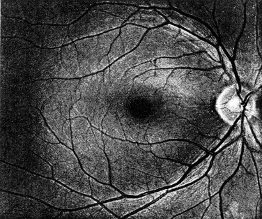 Retinal Nerve Fiber Layer (RNFL) Photography and Computer Analysis