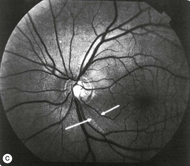 Retinal Nerve Fiber Layer (RNFL) Photography and Computer Analysis