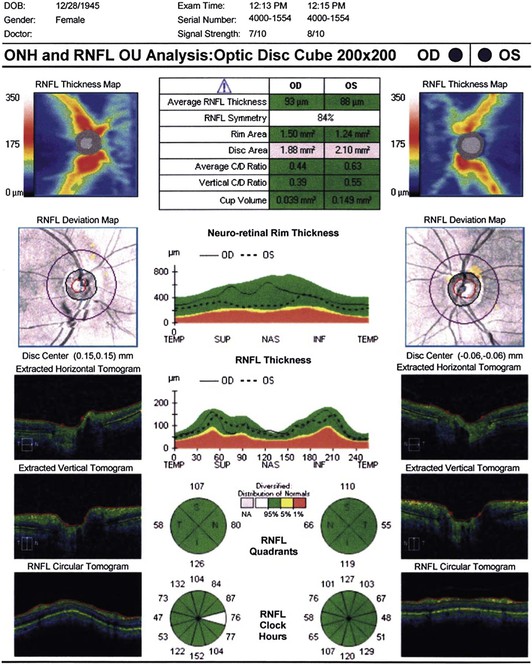 Retinal Nerve Fiber Layer (RNFL) Photography and Computer Analysis