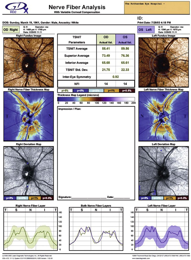 Retinal Nerve Fiber Layer (RNFL) Photography and Computer Analysis