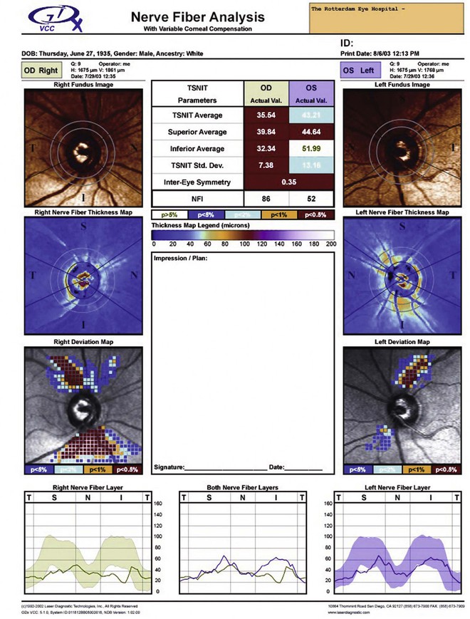 Retinal Nerve Fiber Layer (RNFL) Photography and Computer Analysis