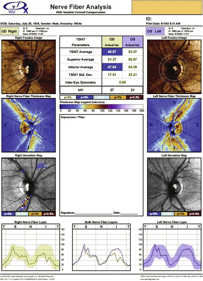 Retinal Nerve Fiber Layer (RNFL) Photography and Computer Analysis