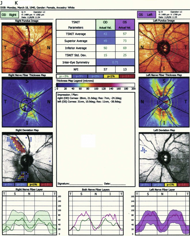 Retinal Nerve Fiber Layer (RNFL) Photography and Computer Analysis