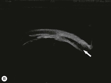 Secondary Angle-Closure Glaucoma