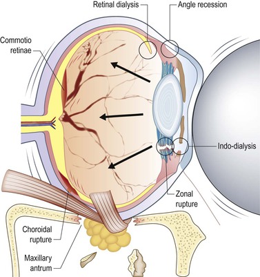 Post-Traumatic Glaucoma