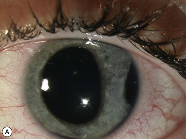 Post-Traumatic Glaucoma