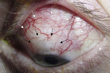 Tenon's Cyst Formation, Wound Healing, and Bleb Evaluation