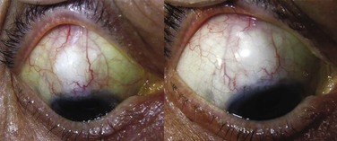 Tenon's Cyst Formation, Wound Healing, and Bleb Evaluation