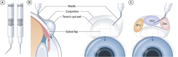 Tenon's Cyst Formation, Wound Healing, and Bleb Evaluation