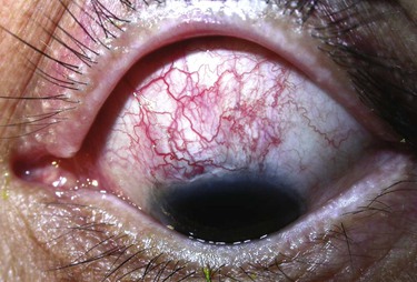 Tenon's Cyst Formation, Wound Healing, and Bleb Evaluation