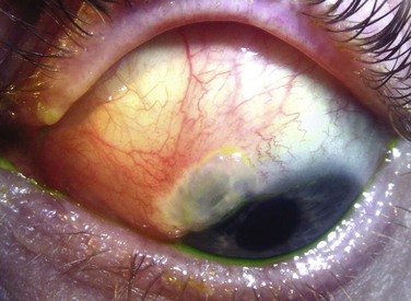 Tenon's Cyst Formation, Wound Healing, and Bleb Evaluation