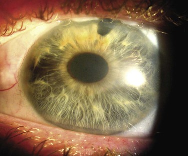 Tenon's Cyst Formation, Wound Healing, and Bleb Evaluation