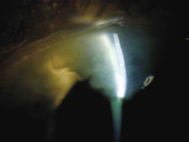 Tenon's Cyst Formation, Wound Healing, and Bleb Evaluation