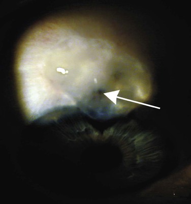Tenon's Cyst Formation, Wound Healing, and Bleb Evaluation