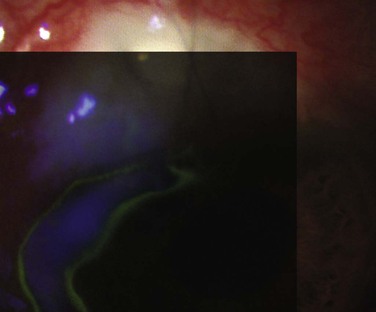 Tenon's Cyst Formation, Wound Healing, and Bleb Evaluation