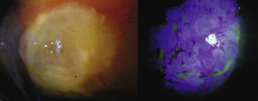 Tenon's Cyst Formation, Wound Healing, and Bleb Evaluation