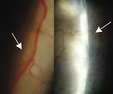Tenon's Cyst Formation, Wound Healing, and Bleb Evaluation
