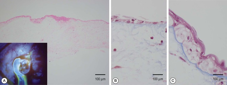 Tenon's Cyst Formation, Wound Healing, and Bleb Evaluation