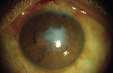 Shallow Anterior Chamber