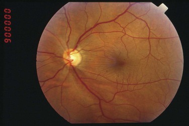 Shallow Anterior Chamber
