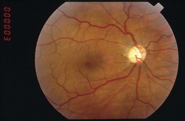 Shallow Anterior Chamber