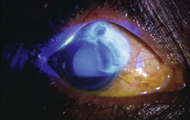 Shallow Anterior Chamber