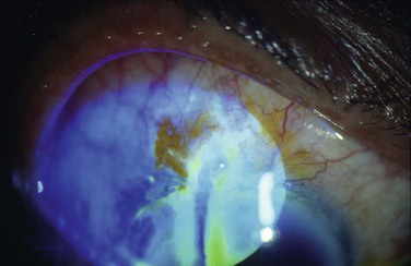Shallow Anterior Chamber