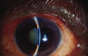 Shallow Anterior Chamber