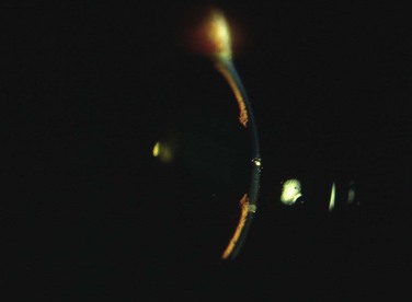 Shallow Anterior Chamber