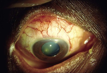 Shallow Anterior Chamber