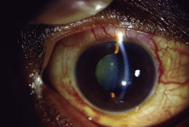 Shallow Anterior Chamber