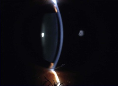 Shallow Anterior Chamber